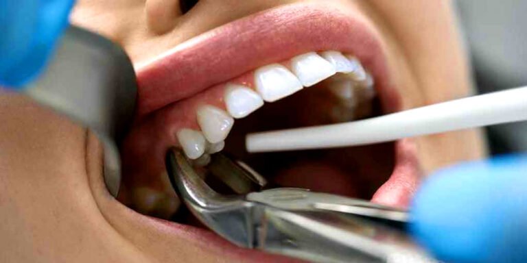 Painless Tooth Extraction in Shyam Park Extension